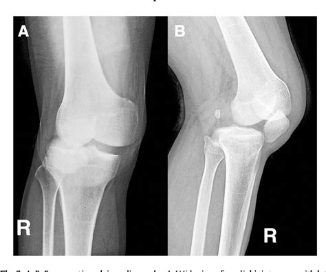 Figure 2 From Open Reduction Of Irreducible Posterolateral Rotary Knee Dislocation Without