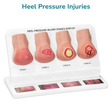 Three Common Sites For Pressure Ulcers And How To Recognize Them