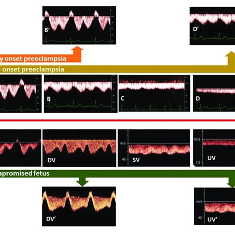 Different Types Of Venous Doppler Waveforms In Maternal And Fetal Download Scientific Diagram