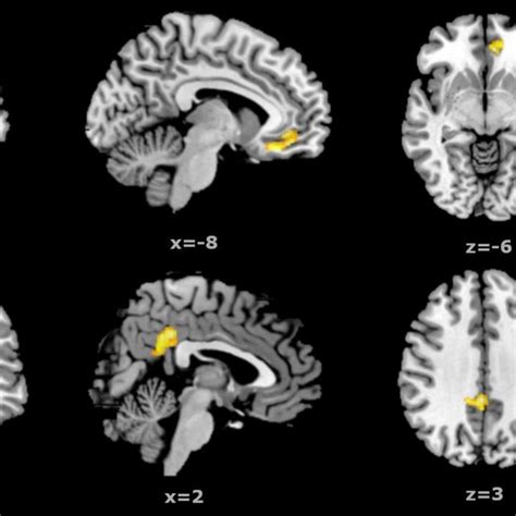 Statistical Parametric Mapping Axial Maximum Intensity Projection Maps Download Scientific Diagram