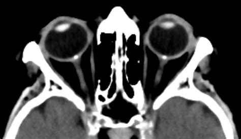 Optic Disc Disorder At Alyssa Camm Blog