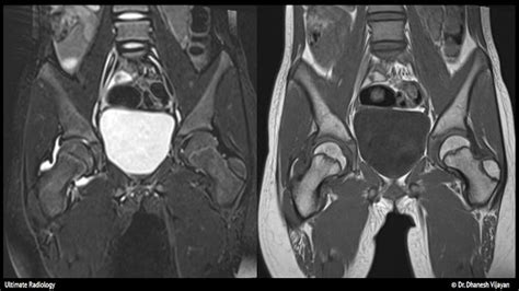 Ultimate Radiology Transient Synovitis Of Hip Joint