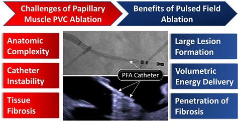 Use Of A Focal Pulsed Field Ablation Catheter To Target Premature
