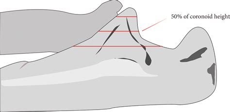 Regan Morrey Classification Type 1 Avulsion Of The Coronoid Process