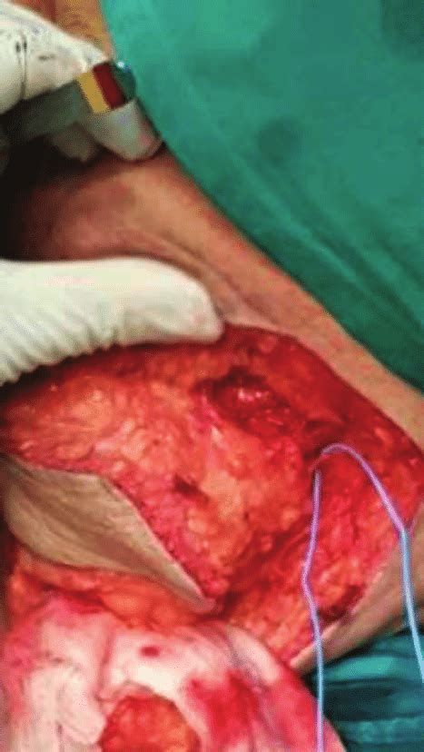 The Perforator Of Internal Pudendal Artery Download Scientific Diagram