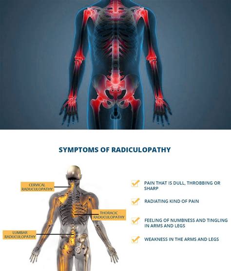 Pinched Nerve Duration Ep Functional Health And Wellness Clinic