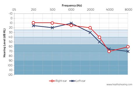 Hearing Loss Frequency Chart Ponasa