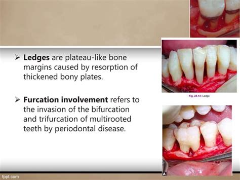 Bone Defects Lecture In Periodontology Pptx Dental Health Diseases And Conditions