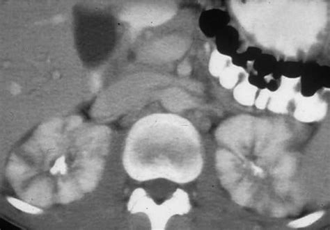 Classic Signs In Uroradiology Radiographics
