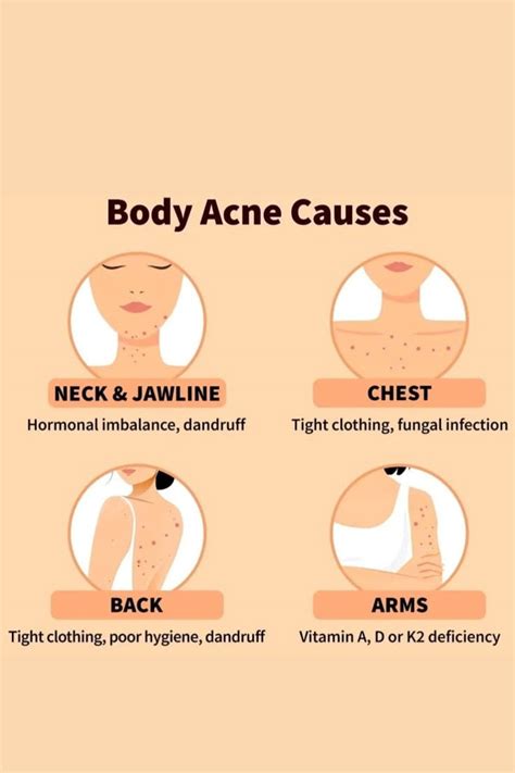 Body Acne Causes Productos Para El Acné Tipos De Acné Estetica De