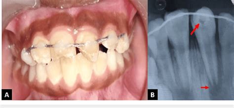 At First Follow Up Visit A Clinical B Radiograph Download Scientific Diagram