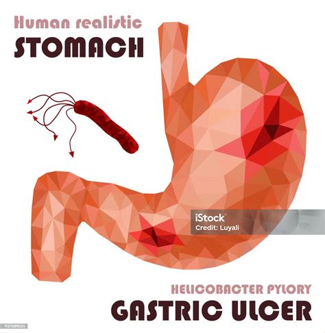 현실적인 낮은 폴 리 인간의 위장과 십이지 장입니다 위 궤 양 질환 헬리코박터 파일로리 박테리아 바이러스 공격 통증 헬리코박터