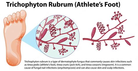 Premium Vector Trichophyton Rubrum Fungal Infection