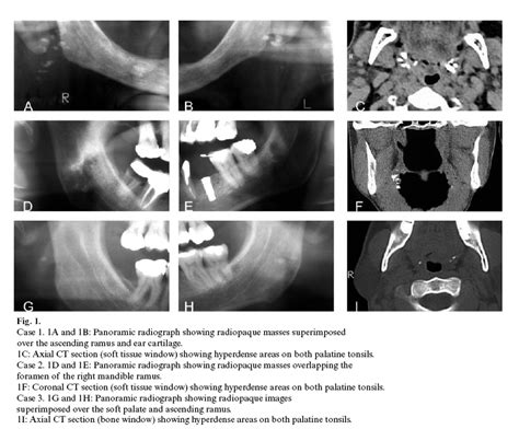 Tonsilloliths Radiograph