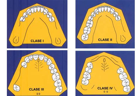 Clasificacion De Kennedy En Odontologia Para Protesis Dental Parcial