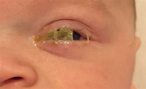 Allergic Conjunctivitis Stringy Discharge