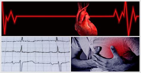 Ежедневието след прекаран инфаркт какво трябва да знаят пациентите Университетска