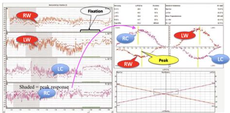 Lecture 9 Caloric Testing I Flashcards Quizlet