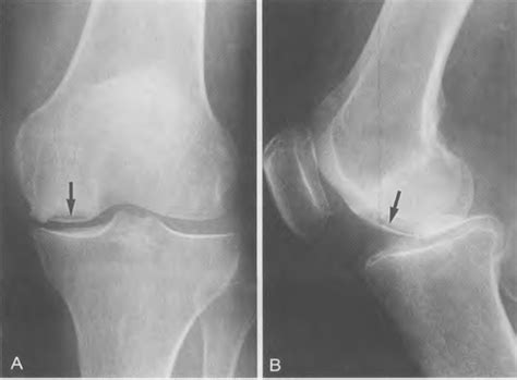 Chapter 9 Articulations Flashcards Quizlet