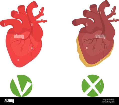 Healthy Heart Vs Unhealthy Heart World Mental Health Day How Does
