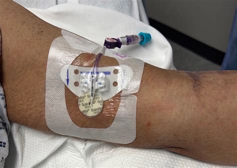 Central Venous Catheter Vascular Wellness