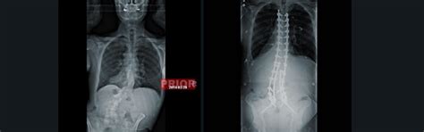 Excessive Kyphosis Neurosurgery