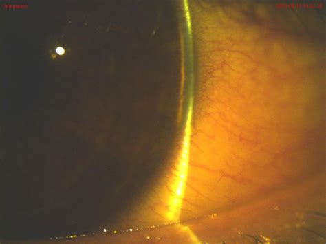 Topiramate Induced Acute Bilateral Angle Closure Glaucoma And Transient