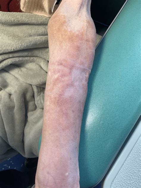 Addressing Venous Extravasation A Concern In Intravenous Iron