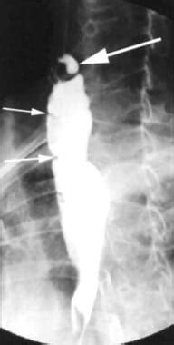 Esophageal Webs And Rings Background Pathophysiology Etiology