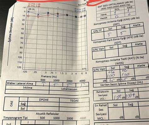 My Extended High Frequency Hearing Loss And Tinnitus Story Help R