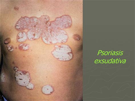 Psoriasis Classification Of Psoriasis презентация онлайн