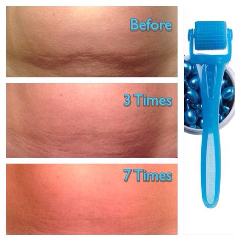 C Section Scar Care Hiccups Pregnancy