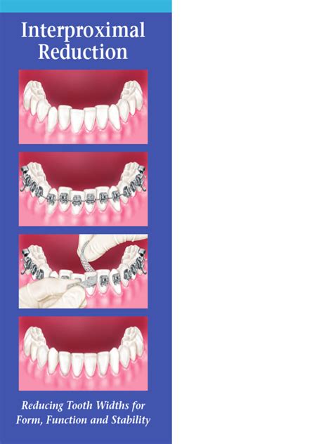 Interproximal Reduction Pdf Orthodontics Dentist