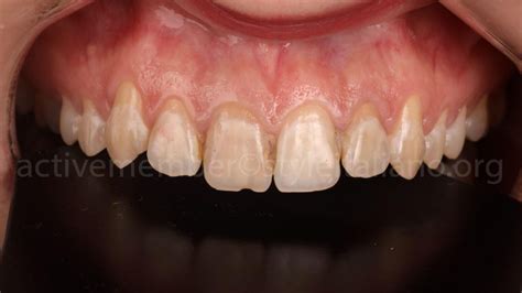 Smile Transformation Using Unica Proximal