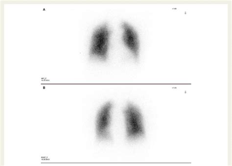 Perfusion Lung Scan No Perfusion Defect Was Detected A Anterior Download Scientific Diagram