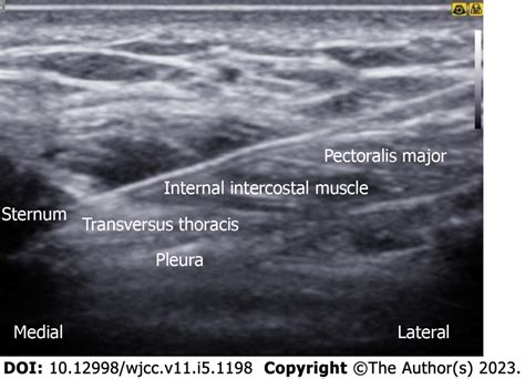 Ultrasonography Of Parasternal Nerve Block Download Scientific Diagram