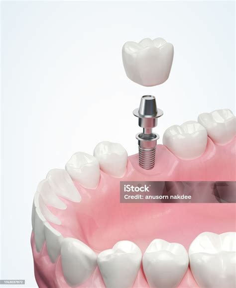 치과 임플란트와 흰 치아와 잇몸 근접 촬영 의료 개념을위한 인간의 치아 3d 그림 치아 임플란트에 대한 스톡 사진 및 기타 이미지 치아 임플란트 0명 건강관리와 의술