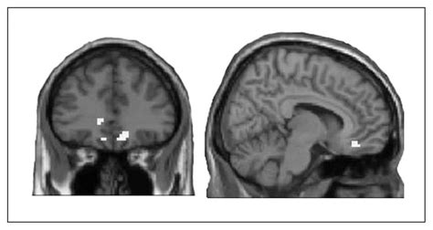 Orbitofrontaler Cortex Understanding The Brain Behind Rebellious