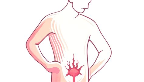 Plasmacytoid Urothelial Cancer Male Age 60