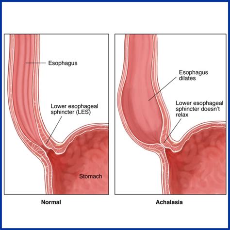 Symptoms Of Esophagus Diseases Gastro Esophageal Reflux Disease Gerd