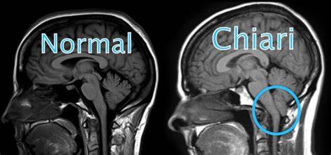 Understanding Chiari Malformation Headache Symptoms And Effective