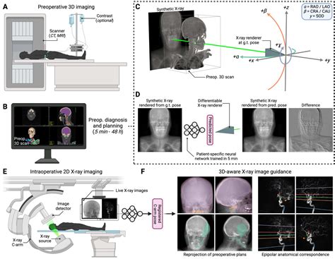 논문 리뷰 Rapid Patient Specific Neural Networks For Intraoperative X Ray To Volume Registration