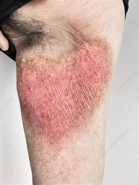 Mycosis Fungoides Stock Image C0602349 Science Photo Library