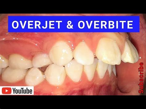 Overjet Teeth