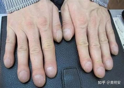 心脏有病，指甲先知？若指甲出现5个征兆，可能是心脏在 报警” 知乎