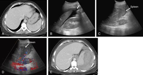 Fast Of The Abdomen Beyond The Basics False Positives Limitations