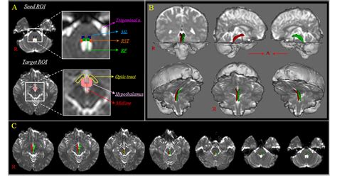 Reticular Activating System Location