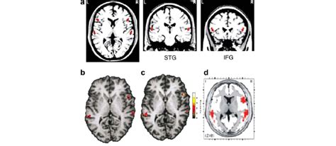 MMN Underlying Sources Revealed By EEG And Conjoint EEG And FMRI Download Scientific Diagram