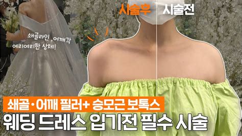 결혼식 전 시술 여리여리 여신패키지 상체 10kg 날씬해보이는 쇄골어깨 필러 패키지 후기 쇄골필러 Youtube