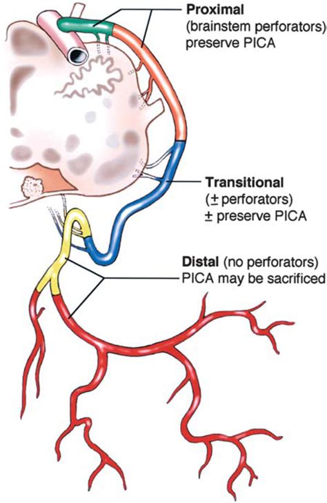 Posterior Inferior Cerebellar Artery Syndrome